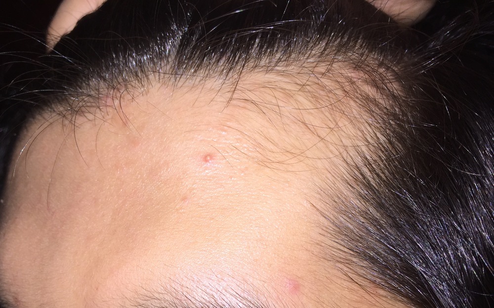 I Can't Tell If Finasteride Is Regrowing My Temple Hairs Or Not, What ...