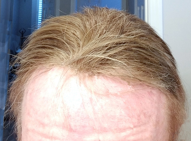 How To Know Where Your Nw1 Hairline Used To Be | HairLossTalk Forums