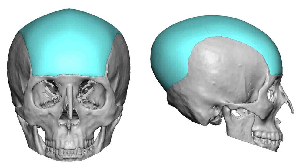 The Role Of Big And Wide Galea In Male Pattern Baldness. | Page 2 ...